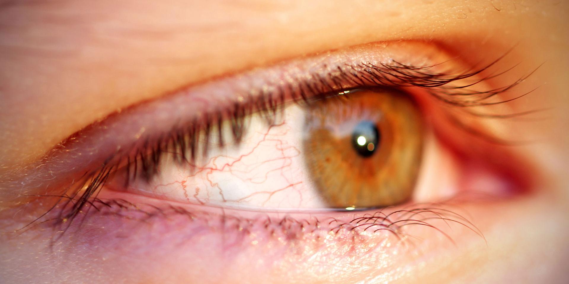 Yeux gonflés, cernés ; rougeurs et sensations de brûlures oculaires