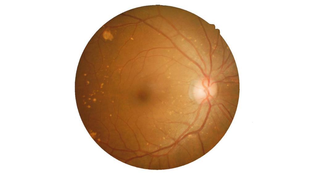 Une vision floue : comment faire face aux problèmes oculaires qui ...